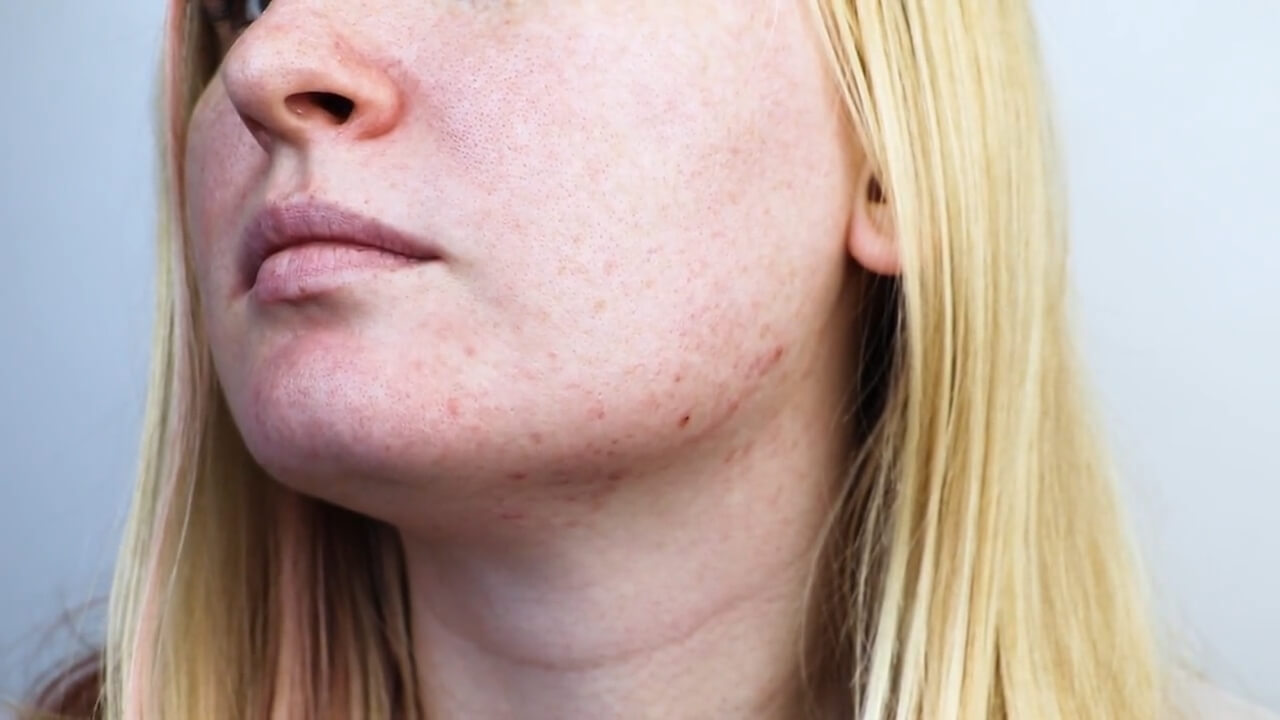Accutane - What You Need to Know About Its Effects on the Body ...